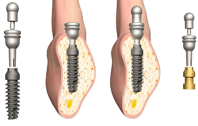 Quantum Implants | Transfers